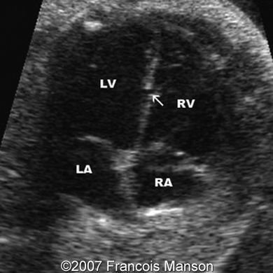 📃 Ventricular septal defect, trabecular type