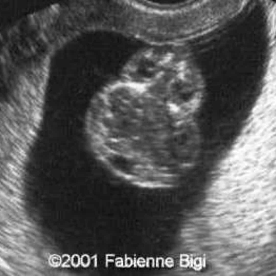 📃 Iniencephaly and acrania