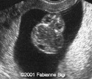 📃 Iniencephaly and acrania