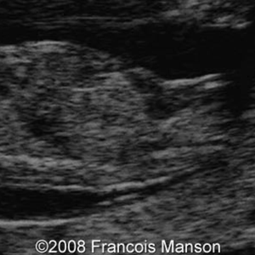 Trisomy Chromosome 15