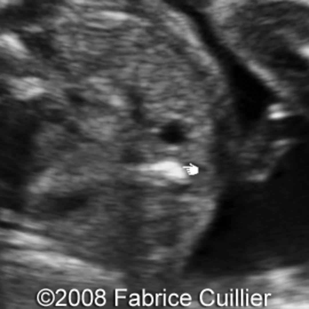 📃 Hepatic calcifications