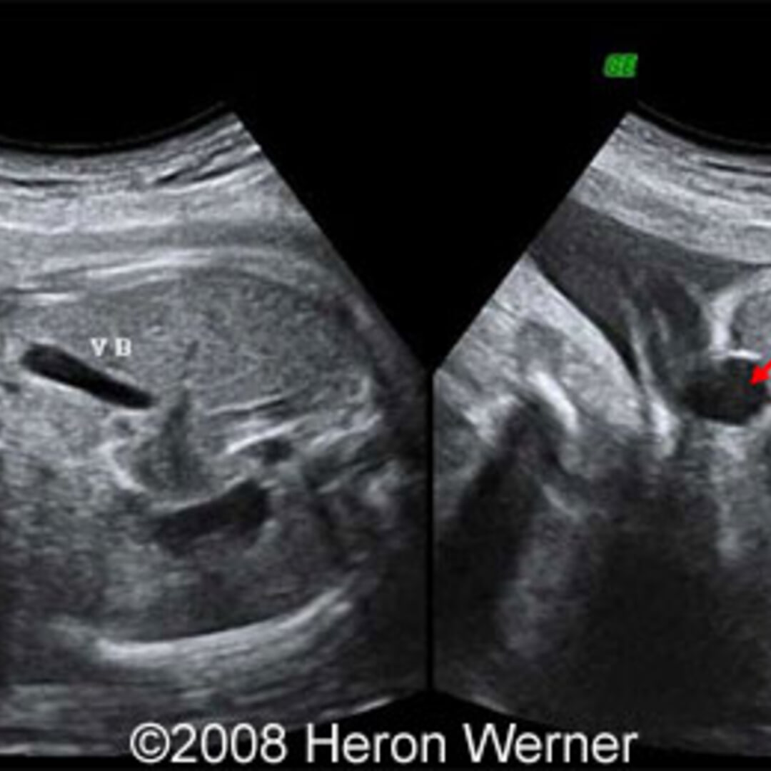 📃 Umbilical vein varix
