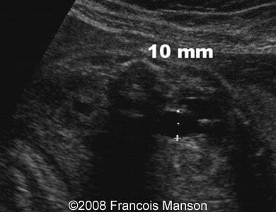 📃 Pyelectasis, unilateral