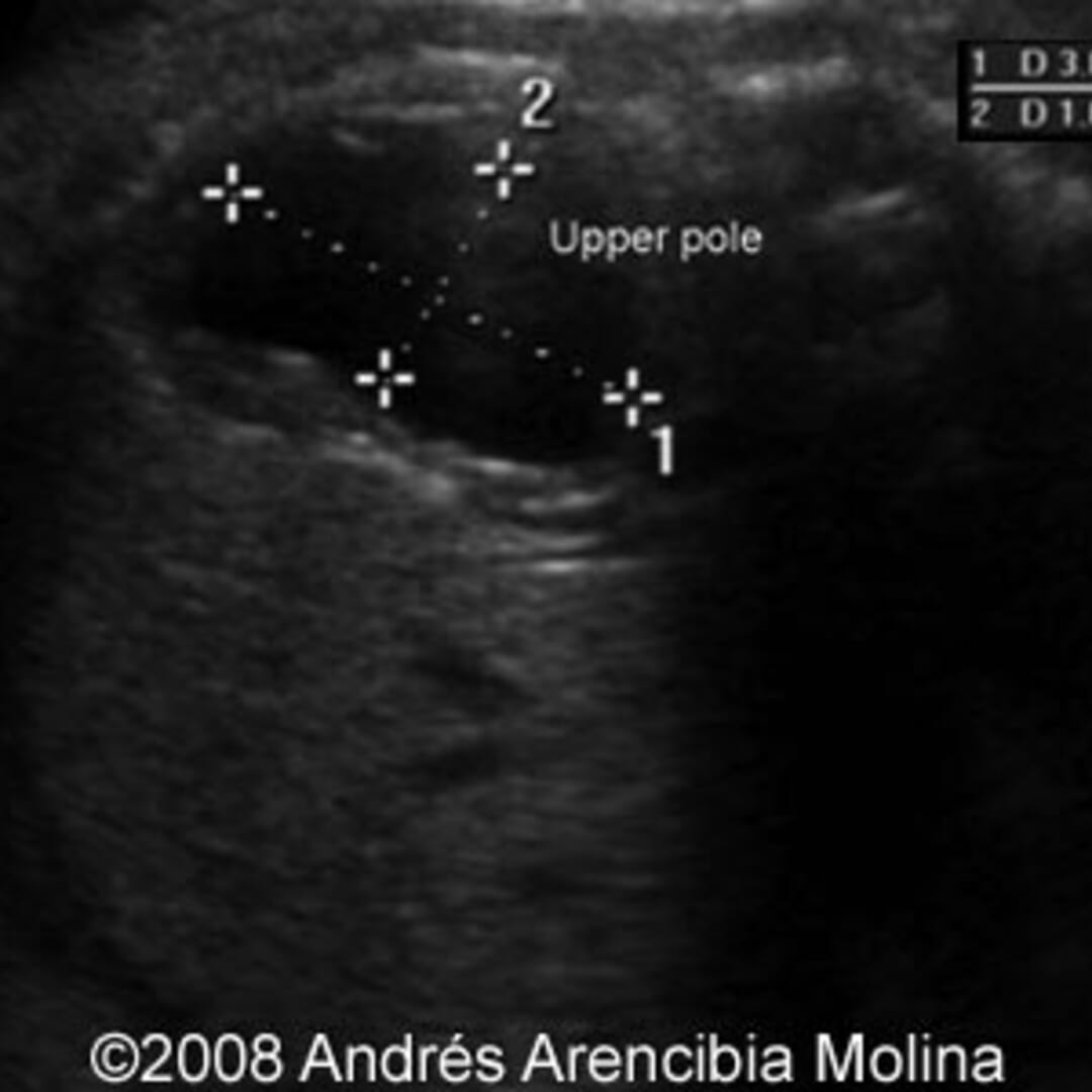 📃 Primary vesicoureteral reflux and duplex kidney