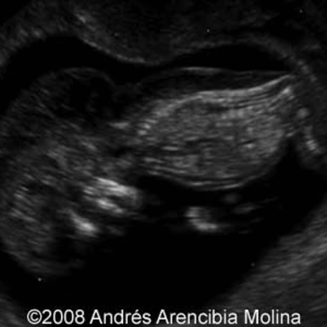 📃 Partial trisomy 6q associated with hydrops and early fetal malformations