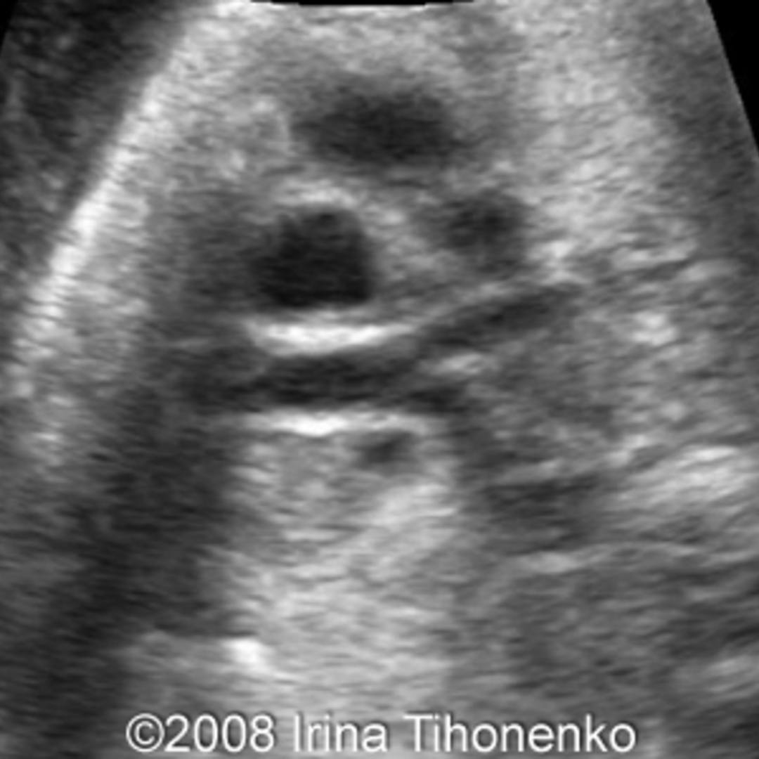 📃 VACTERL association