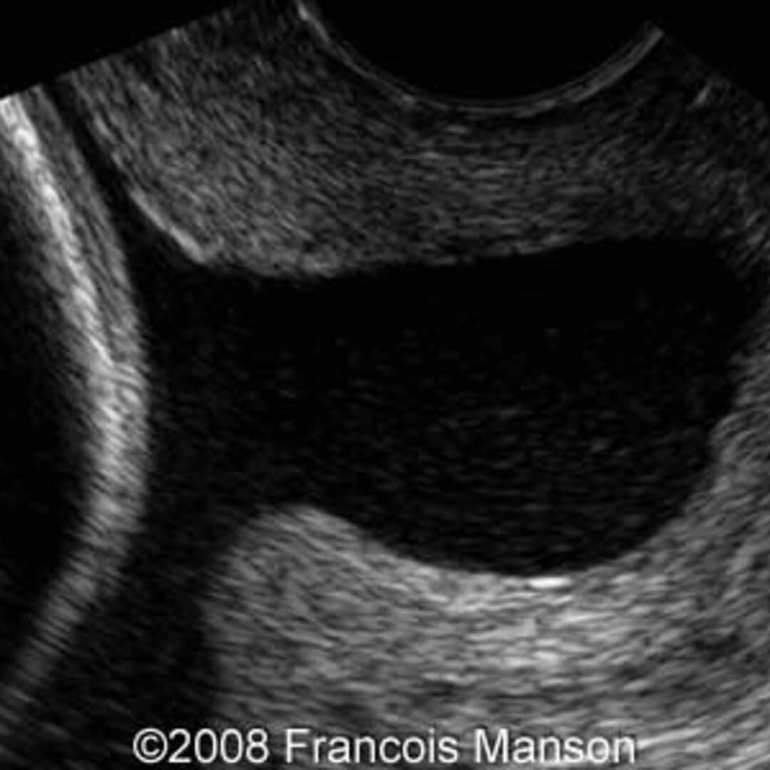 📃 Cervical incompetence