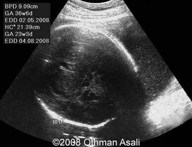 📃 Ellis-van Creveld syndrome