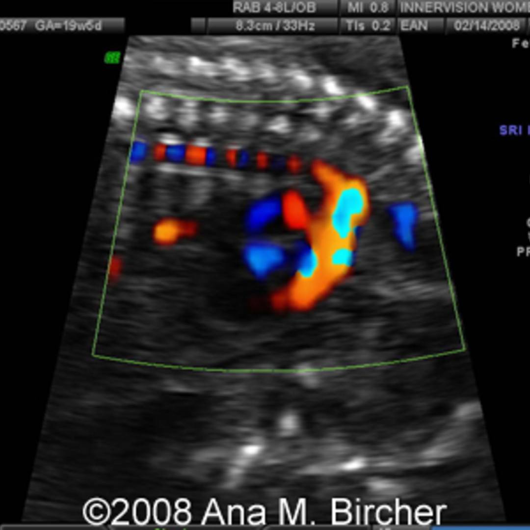 📃 Doppler artifact