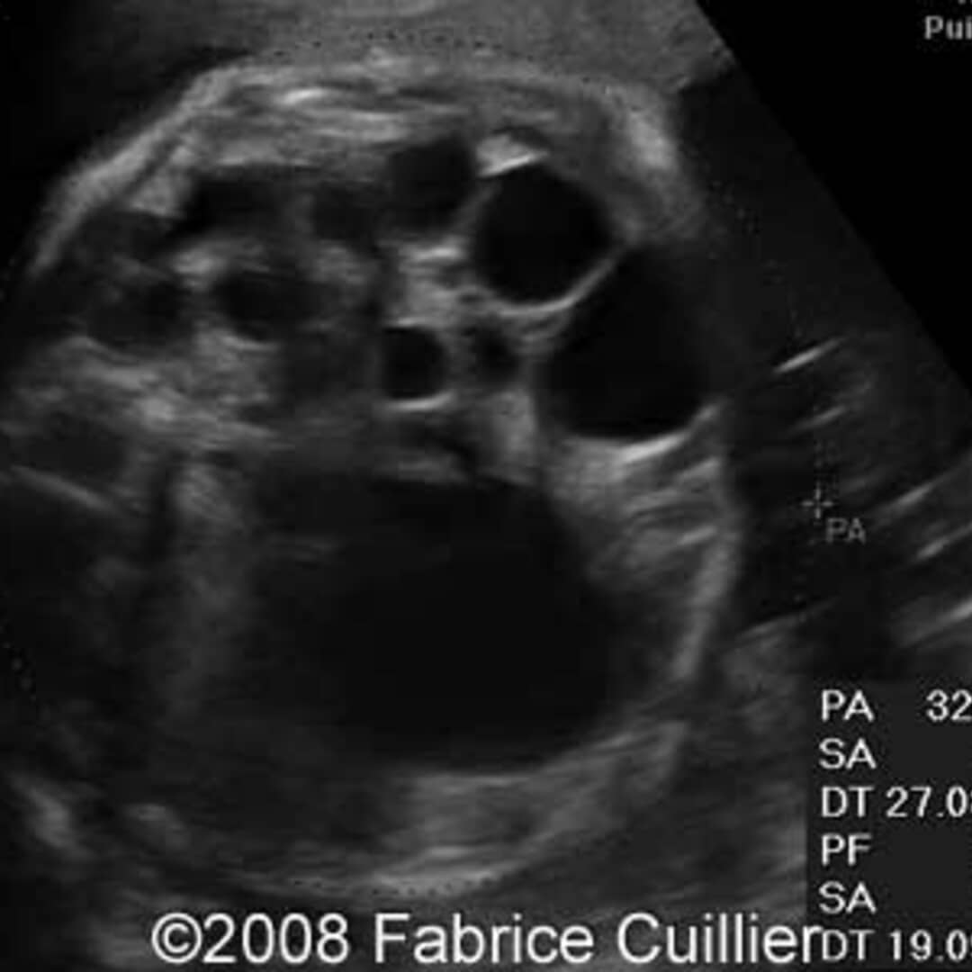 📃 Multicystic dysplastic kidney disease, unilateral, 32 weeks