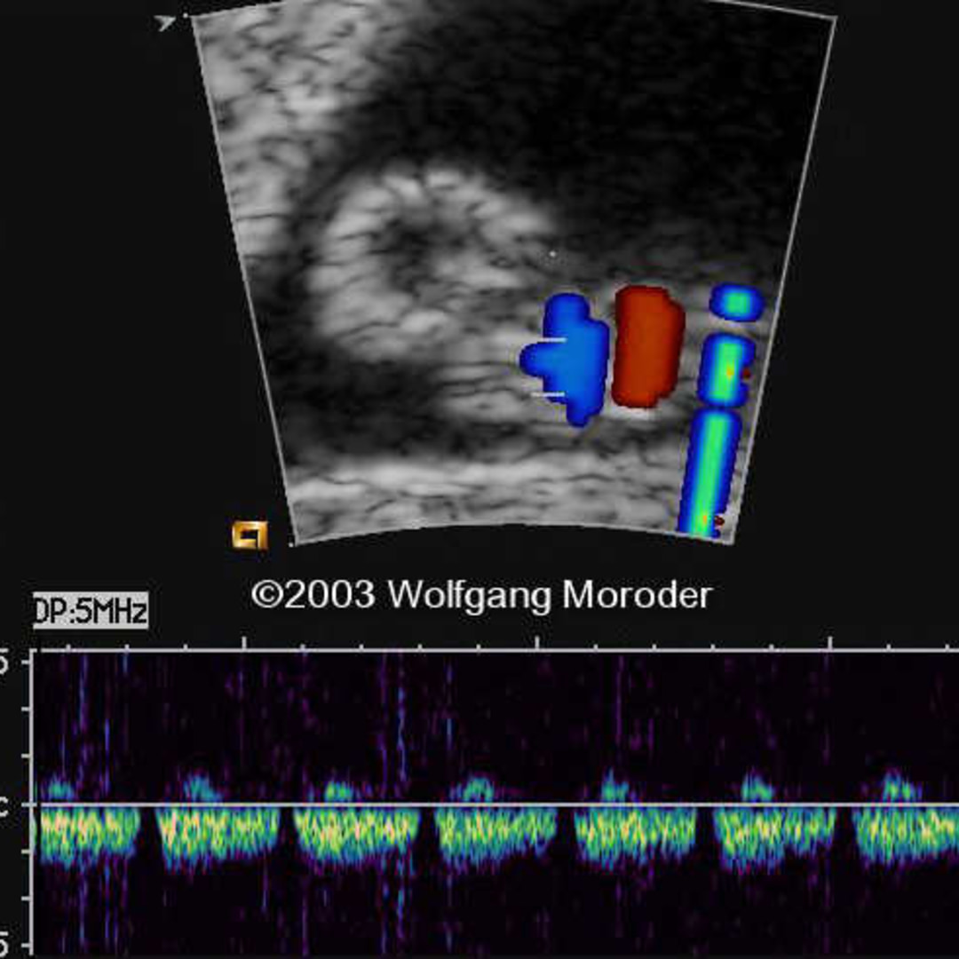 📃 Ductus venosus Doppler, 6 weeks