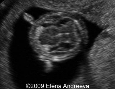 📃 Otocephaly, agnathia, holoprosencephaly - 12 weeks
