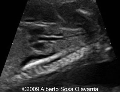 📃 Interrupted aortic arch, type B