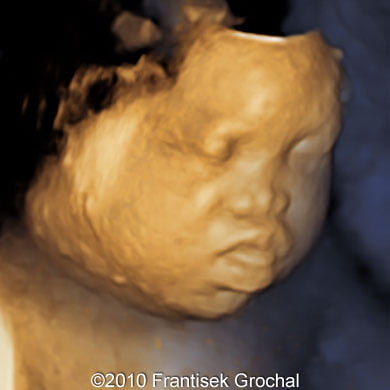 trisomy 21 scan