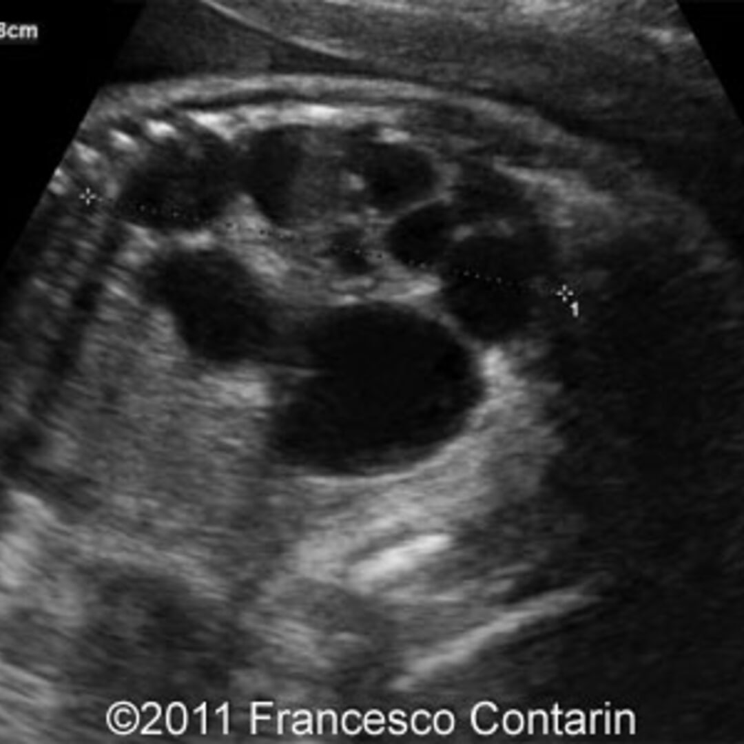 📃 Multicystic kidney disease