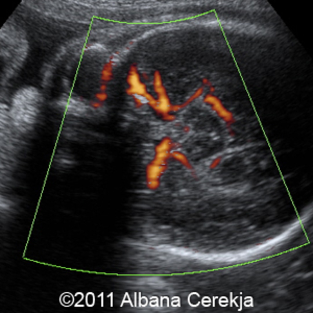 📃 Duplication of the middle cerebral artery