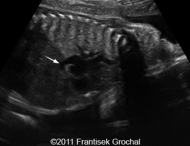 📃 Vena cava inferior interruption, persistent right umbilical vein