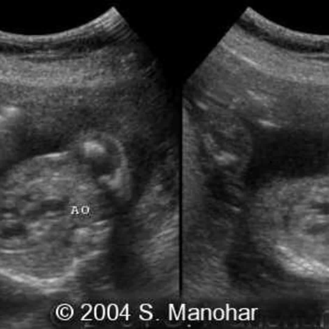 Heart Block Second Degree heart-block-second-degree