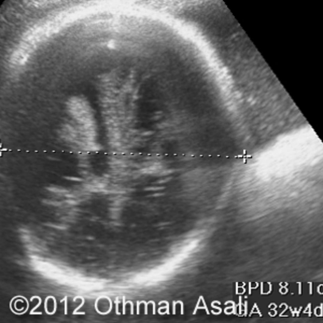 📃 Multicystic encephalomalacia