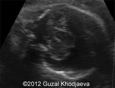 📃 Holoprosencephaly,cebocephaly, metopic sinostosis, trisomy 18