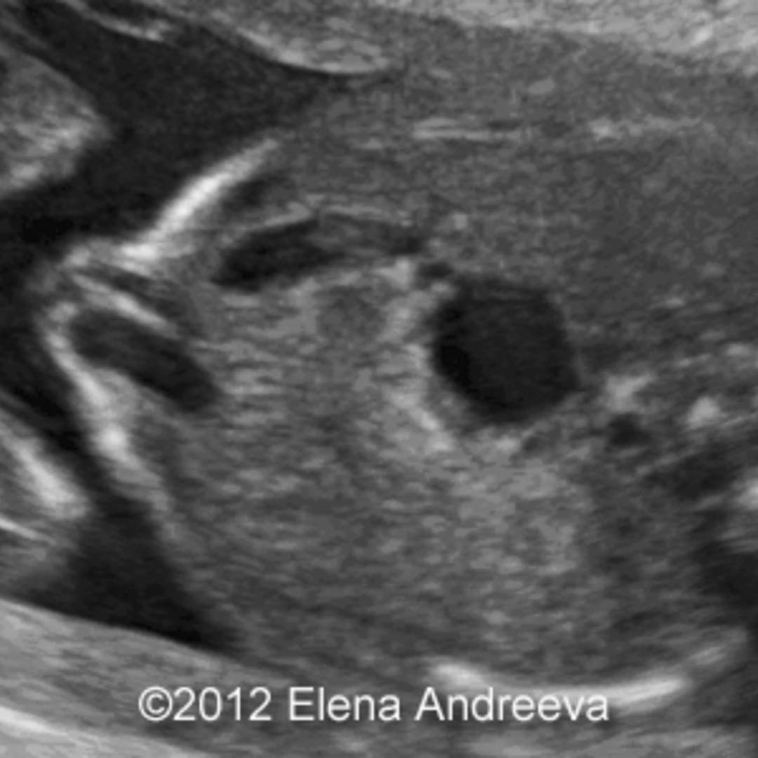 📃 Choledochal cyst