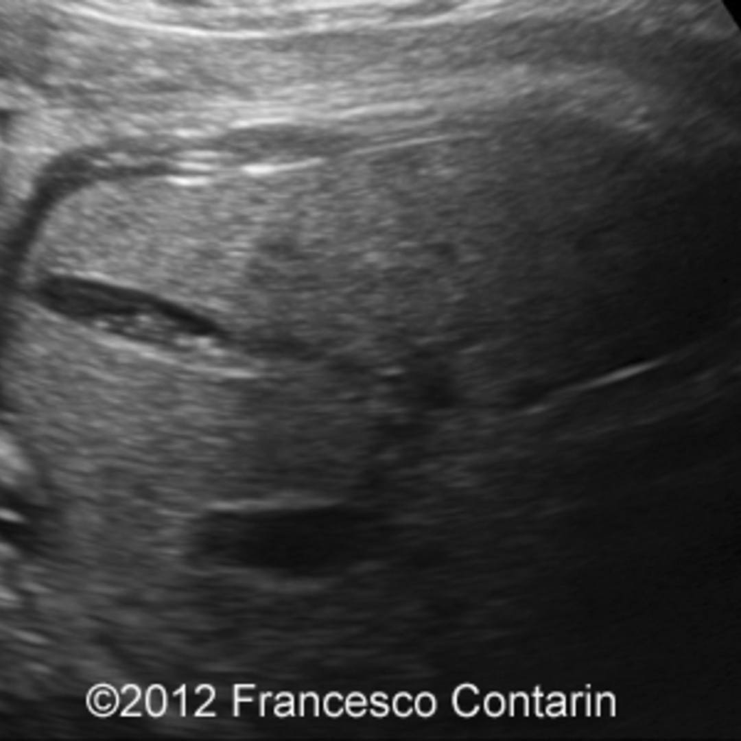 📃 Gallbladder sludge