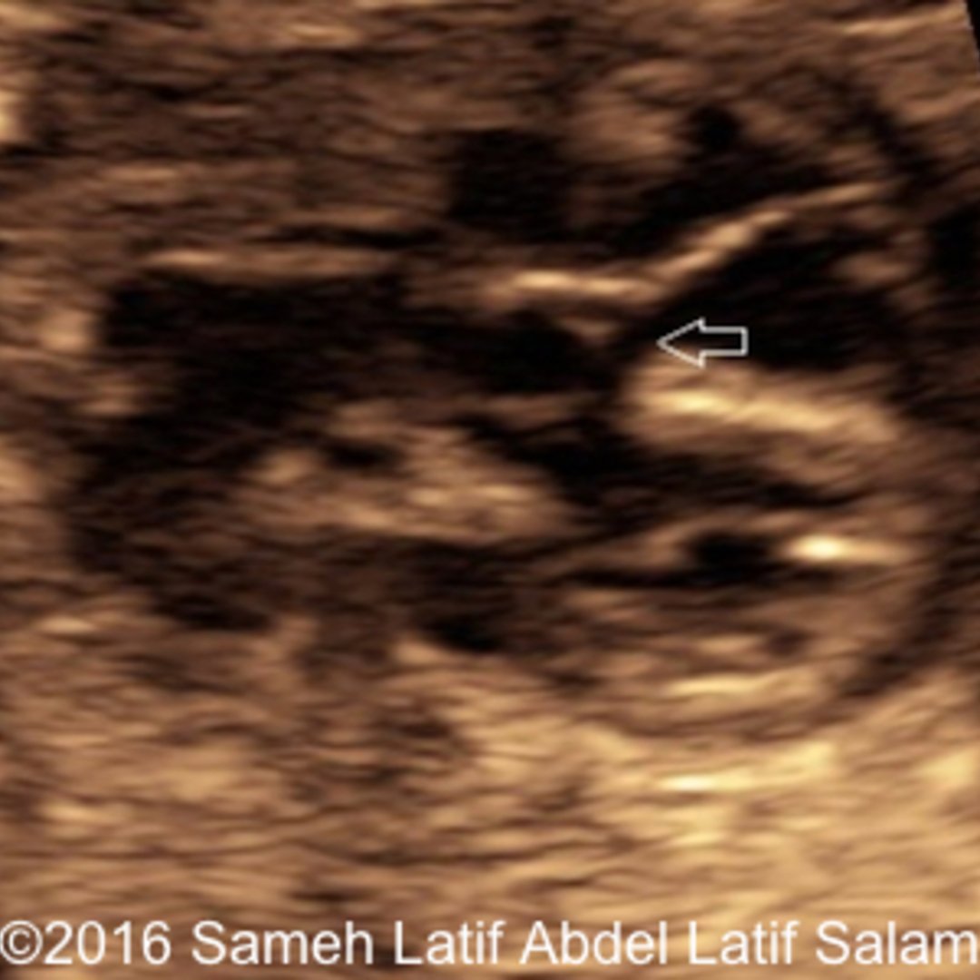 📃 Conoventricular septal defect