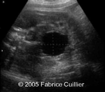 📃 Posterior urethral valves, 32 weeks