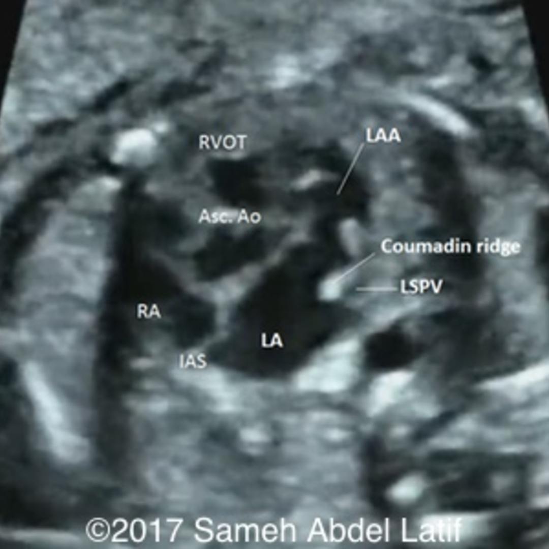 📃 Nodular coumadin ridge