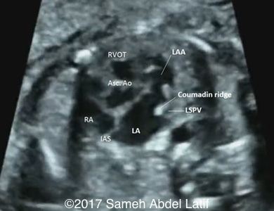 📃 Nodular coumadin ridge