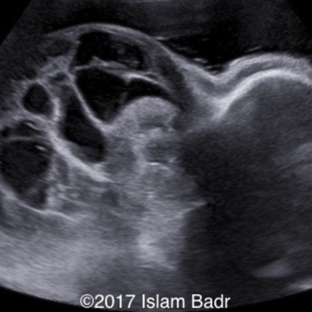📃 Neurogenic bladder