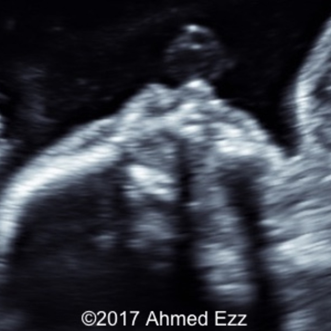 📃 Treacher Collins syndrome