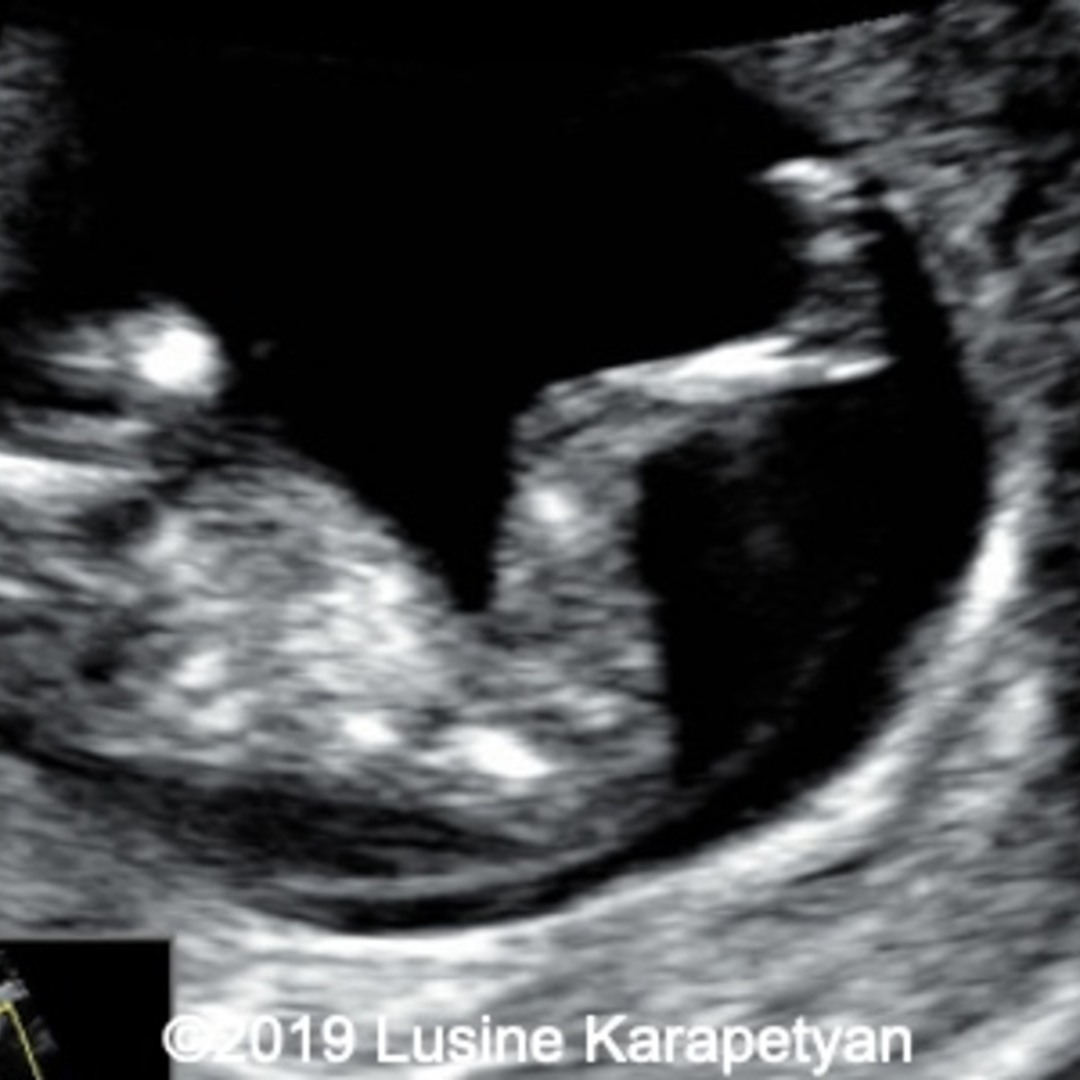 📃 Fibular hemimelia associated with proximal focal femoral deficiency