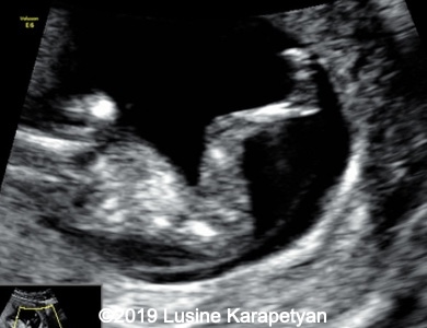 📃 Fibular hemimelia associated with proximal focal femoral deficiency