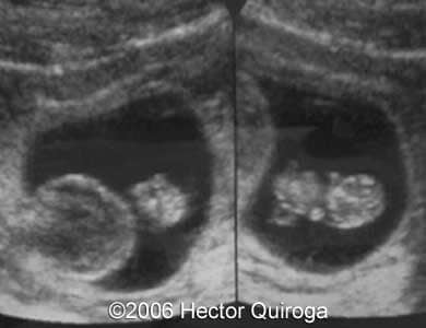 📃 Subamniotic hematoma