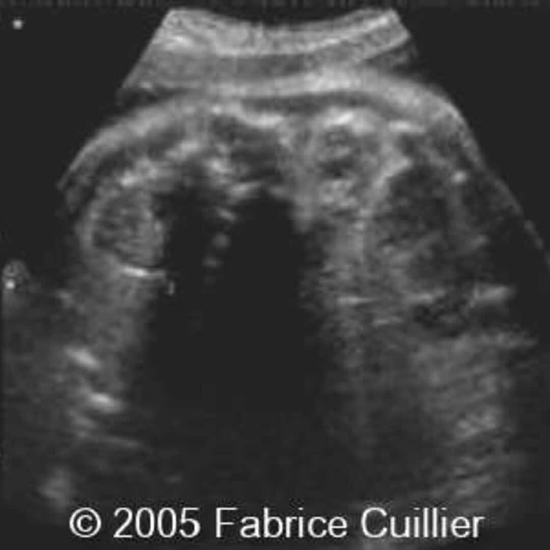 📃 Hypoplastic kidney, unilateral