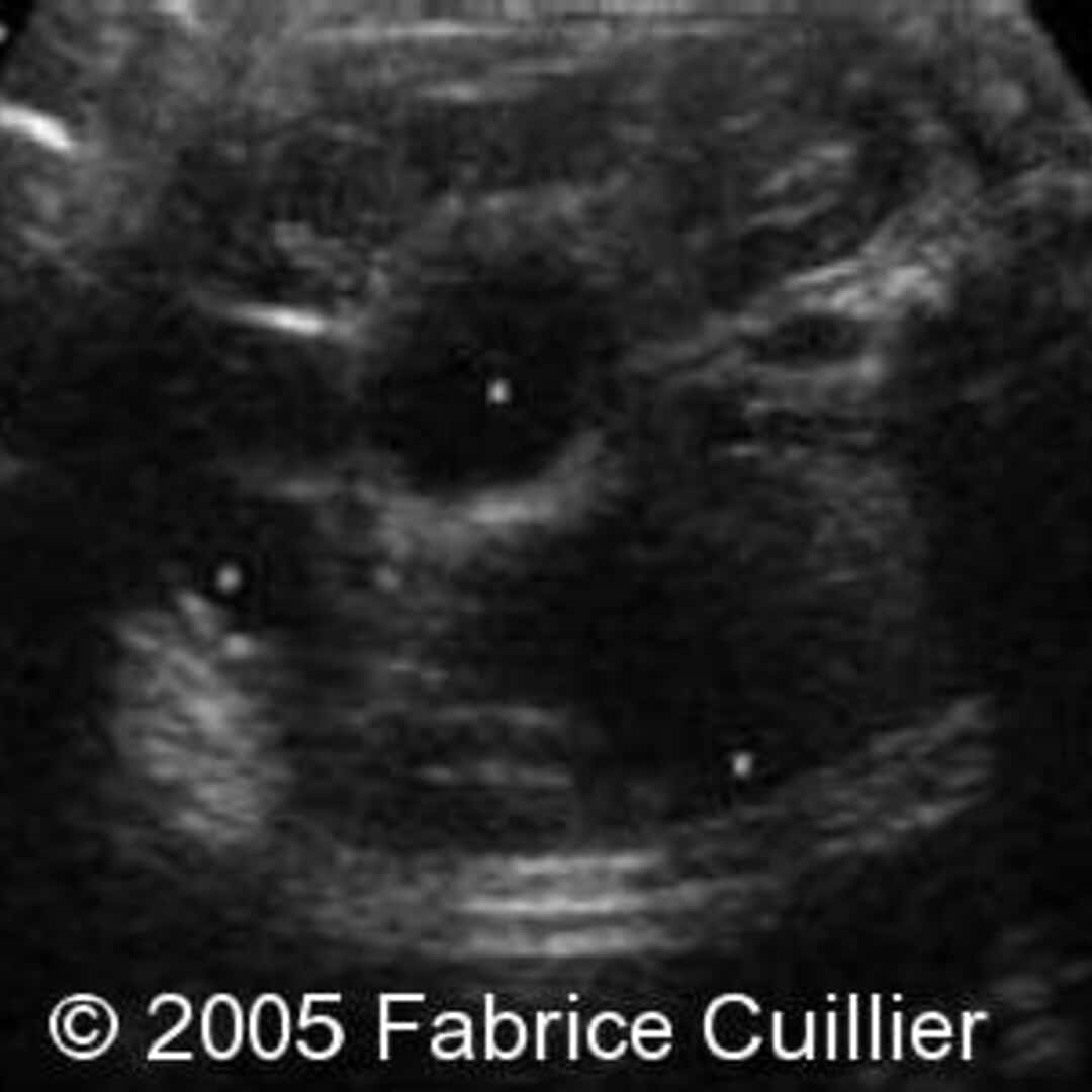 📃 Obstructive uropathy resulting in urinoma formation
