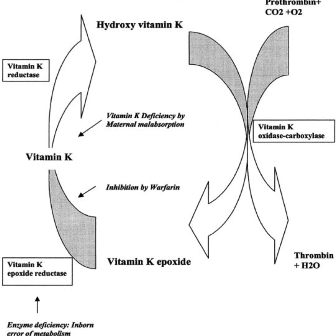 📃 Binder syndrome with brachytelephalangy secondary to maternal vitamin ...
