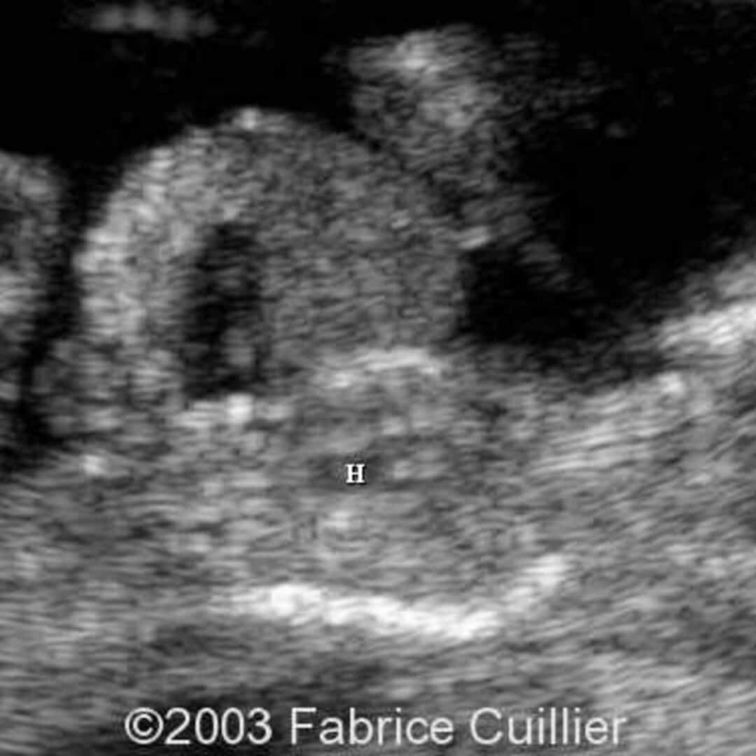 📃 Omphalocele, 3D representation