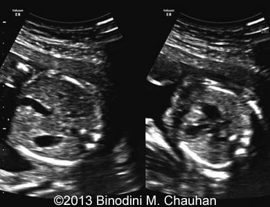 📃 Hypoplastic right heart syndrome