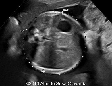 📃 Partial molar pregnancy with normal diploid fetus