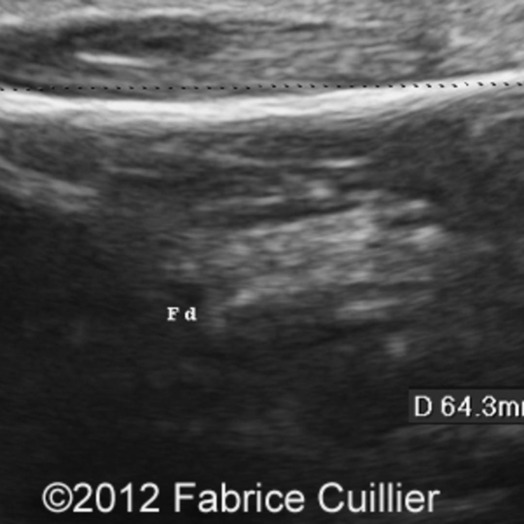📃 Benign curved tibia