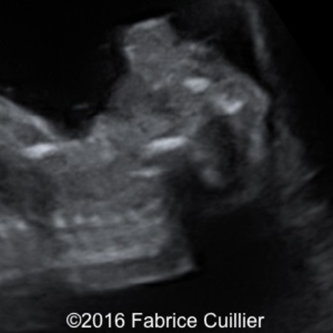 📃 Otocephaly - Agnathia - Holoprosencephaly - Acrania