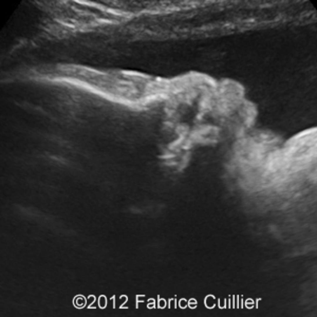 📃 Subependymal pseudo-cyst, bilateral