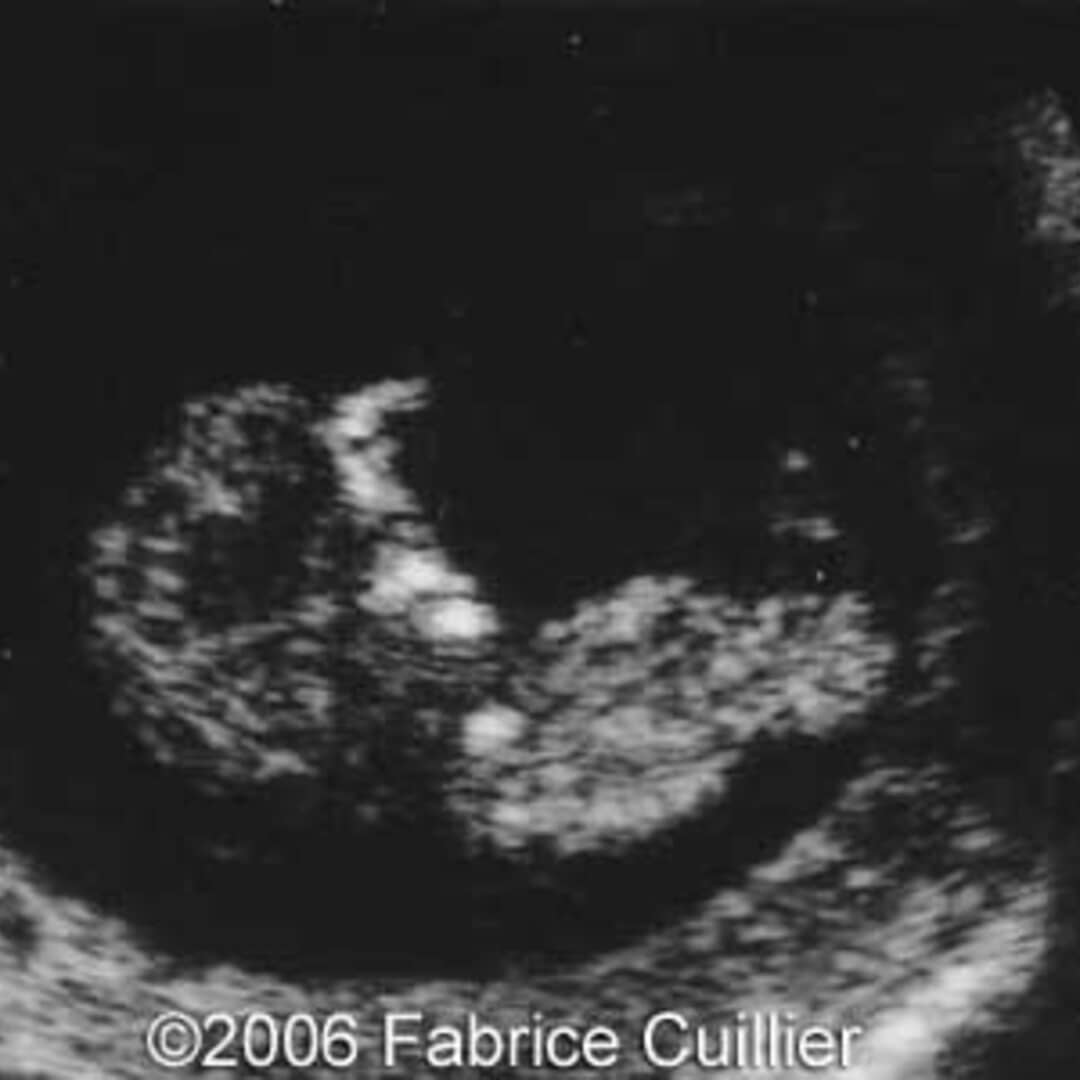 📃 Two- and three-dimensional sonography in early diagnosis of limb-body ...