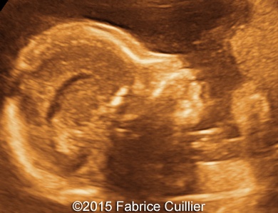 📃 CHARGE syndrome