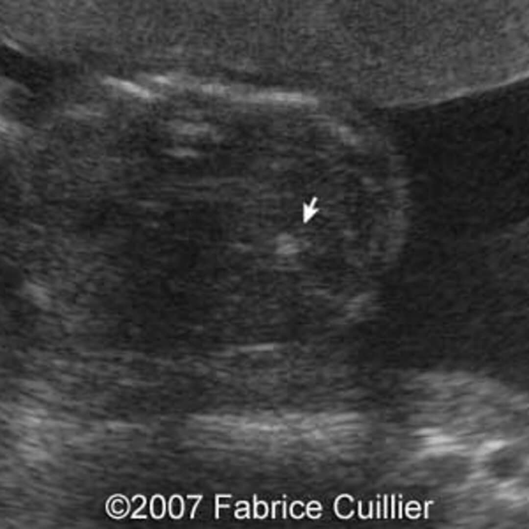 📃 Idiopathic liver calcifications