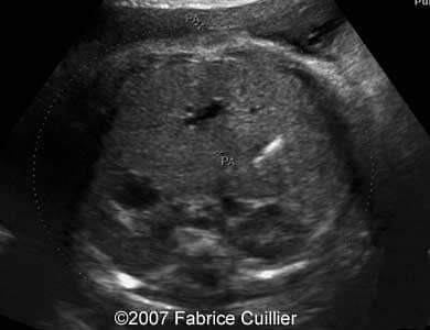 📃 Prenatal diagnosis of fetal gallstones