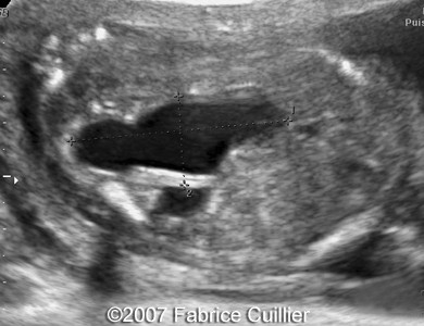 📃 Congenital megaurethra