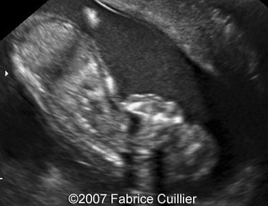 📃 Acrania, 14 week, 2D and 3D